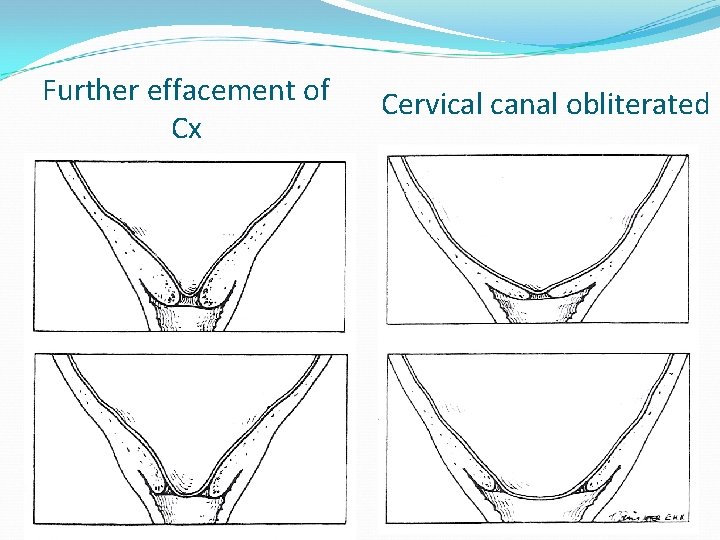 Lecture 5 PHASES OF PARTURITION STAGES OF LABOR