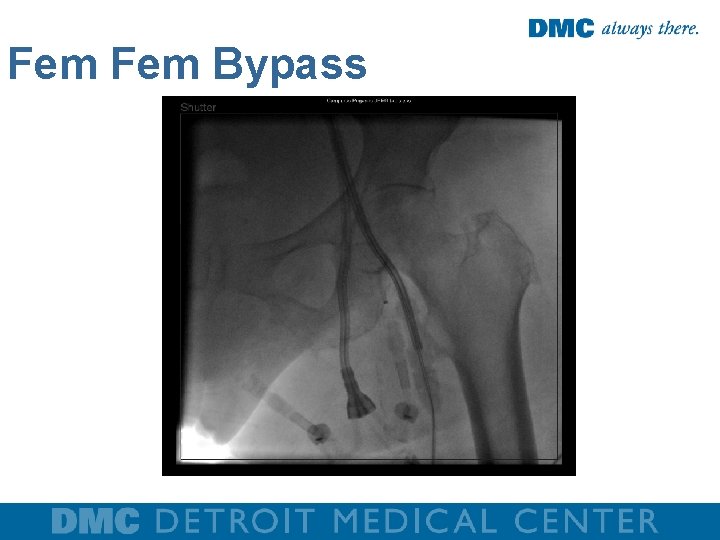 Impella in Elderly LM STEMI Theodore L Schreiber