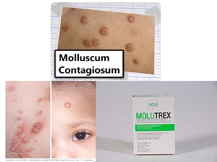 Skin Conditions II Corn and Calluses Treatment Nonpharmacologic