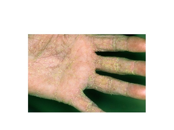 Skin Conditions II Corn and Calluses Treatment Nonpharmacologic