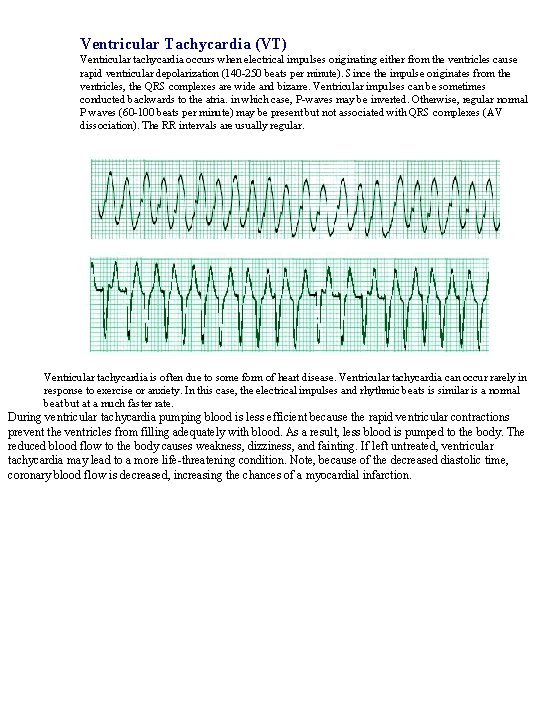 Ventricular Tachycardia VT Ventricular tachycardia occurs when electrical