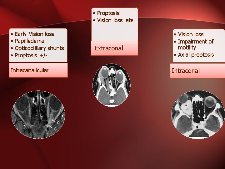 Orbital tumors Clinical evaluation Six ps of orbital