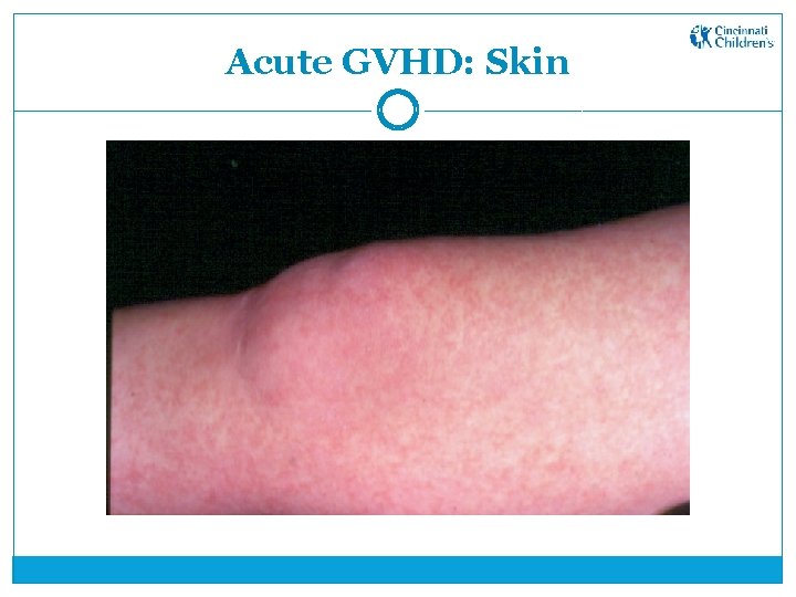 Photopheresis in a Pediatric Population MARY ANN MICHAEL