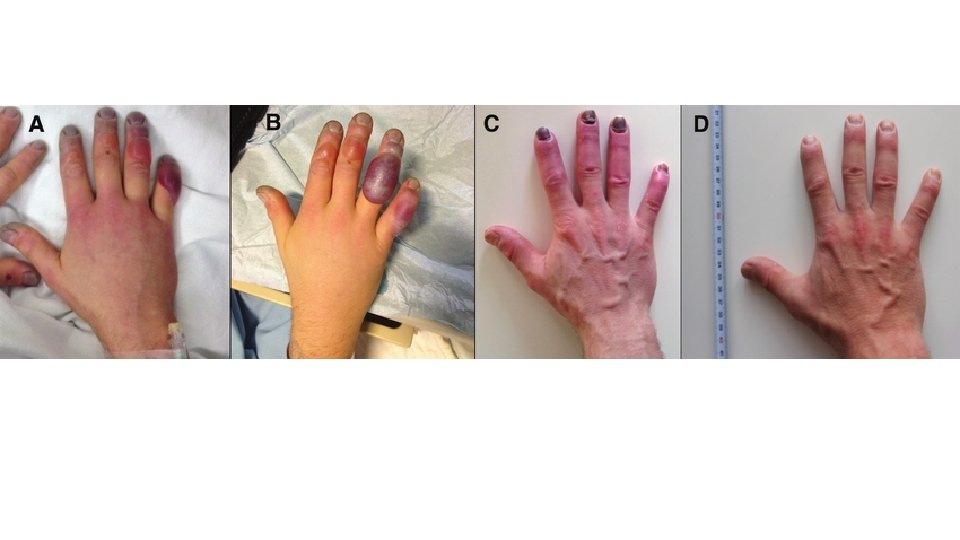 FROSTBITE Definition Pathophysiology Localized coldinduced injury due to