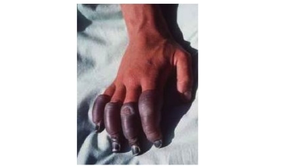 FROSTBITE Definition Pathophysiology Localized coldinduced injury due to