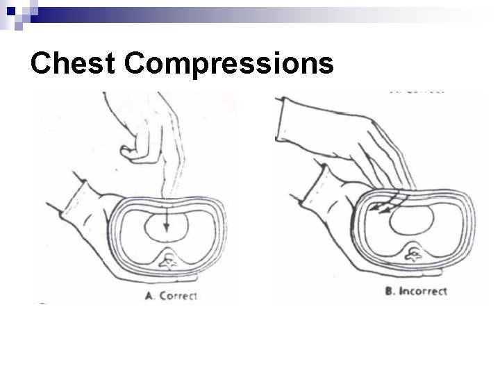 Chest compressions Indication n If after 30 seconds