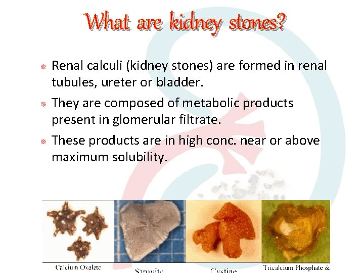 Lab 4 Renal Calculi What are kidney stones