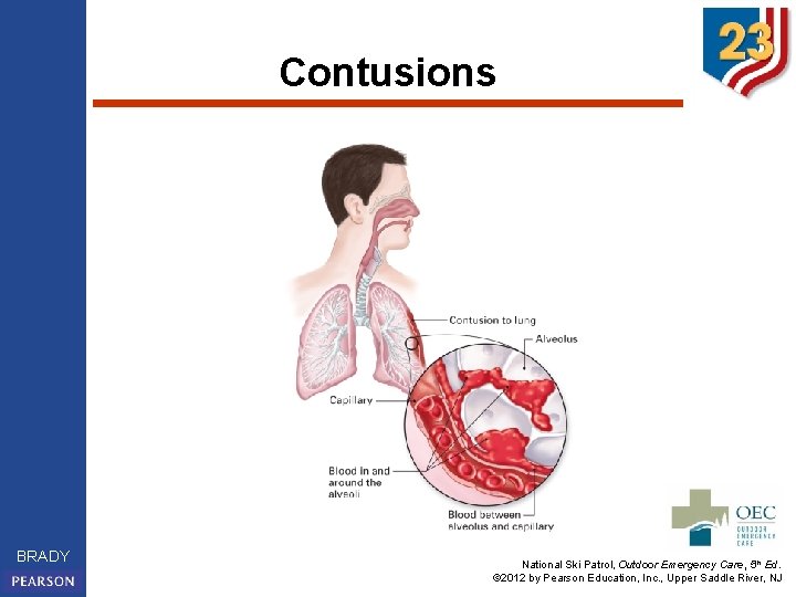 Chapter 23 Thoracic Trauma BRADY National Ski Patrol
