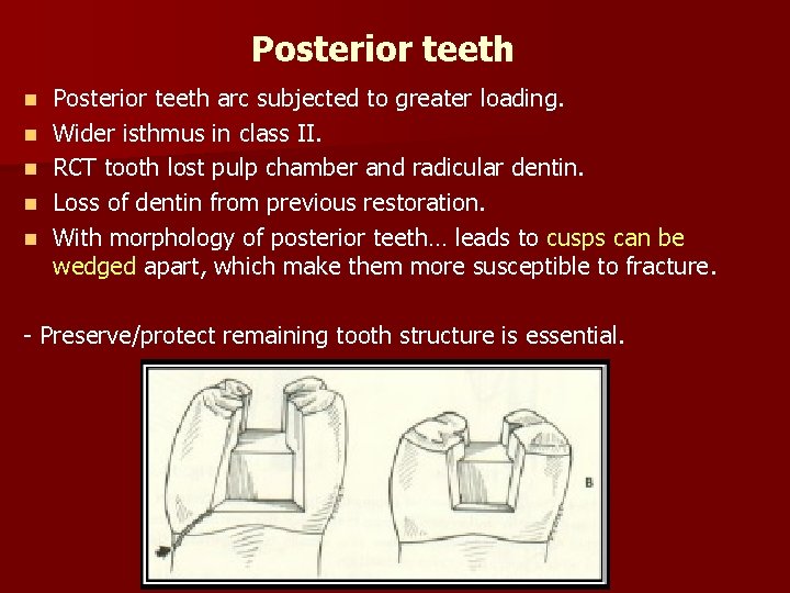 Endodontic Restoration of Endodontically Treated Teeth Part 1