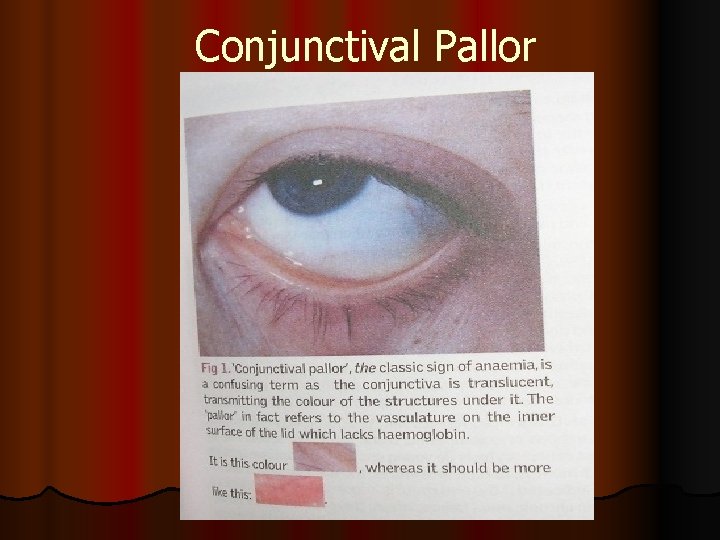 Anemia in Pregnancy Rajeev Ojha Table 1 Blood