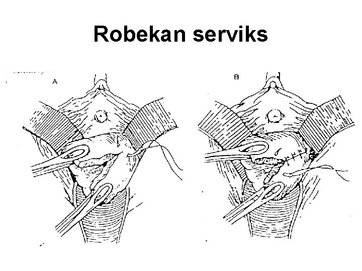 TRAUMA ORGAN GENITALIA PEREMPUAN 1 Perlukaan akibat persalinan