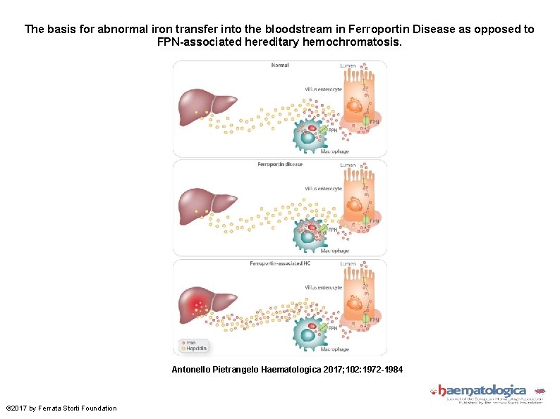 Ferroportin disease pathogenesis diagnosis and treatment by Antonello