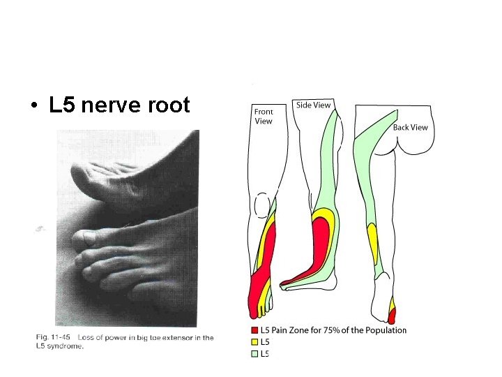 Lumbar Disc Herniation LIAO Hui MD Tongji Hospital