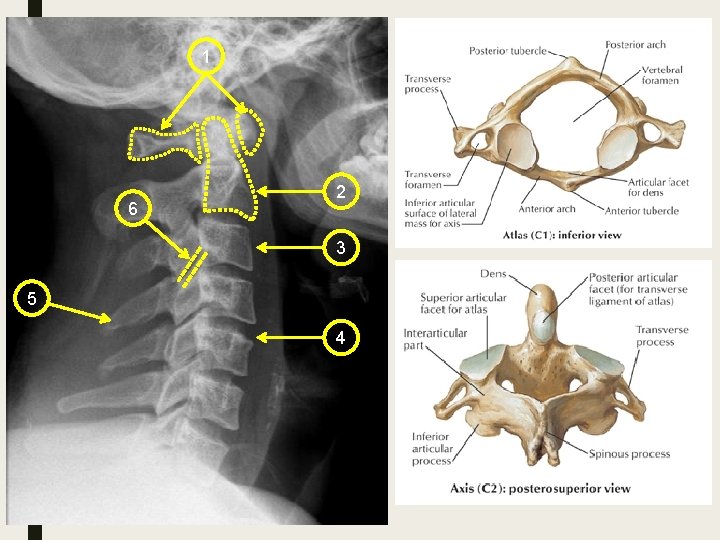 RADIOLOGICAL ANATOMY OF THE VERTEBRAE Practical 1 Radiology