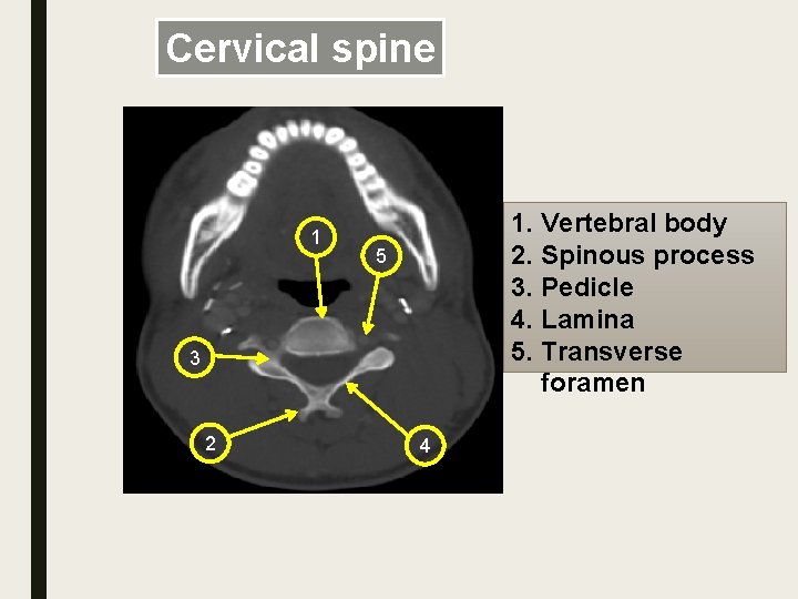 RADIOLOGICAL ANATOMY OF THE VERTEBRAE Practical 1 Radiology
