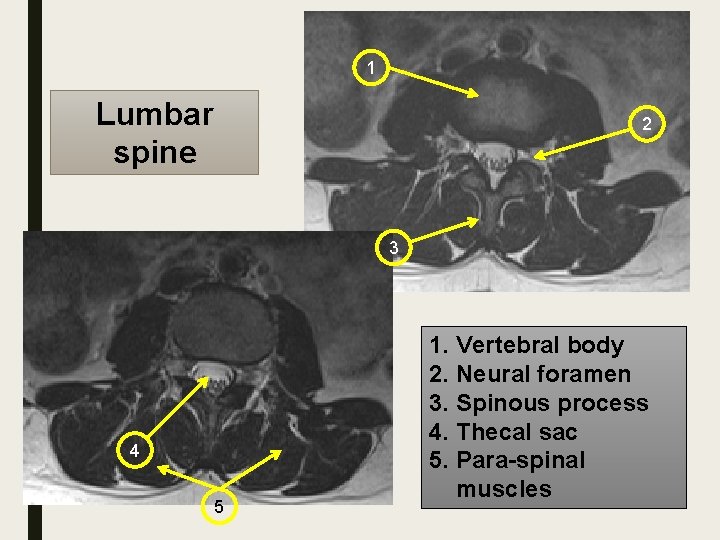 RADIOLOGICAL ANATOMY OF THE VERTEBRAE Practical 1 Radiology