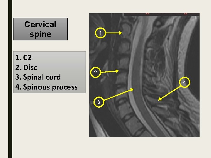 RADIOLOGICAL ANATOMY OF THE VERTEBRAE Practical 1 Radiology