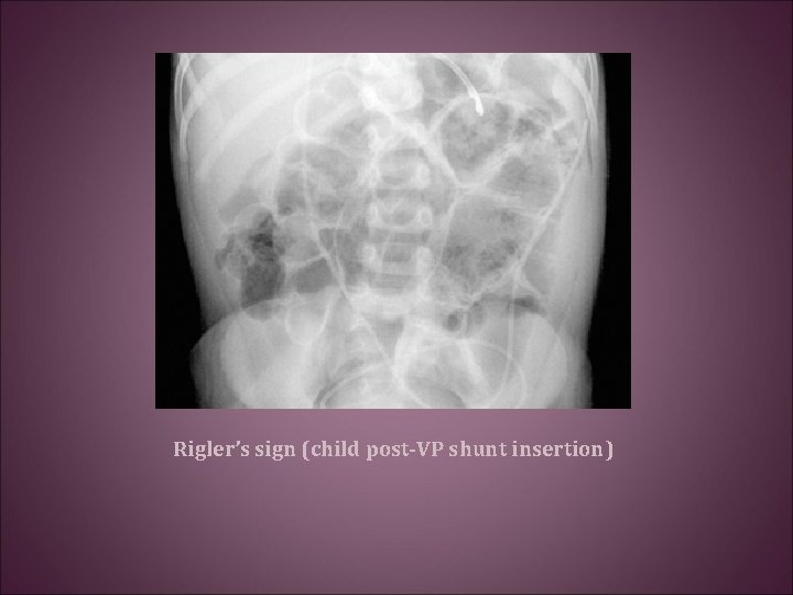 Necrotising enterocolitis Why you need to know about