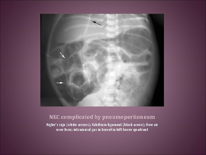 Necrotising enterocolitis Why you need to know about
