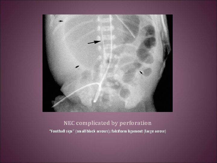 Necrotising enterocolitis Why you need to know about