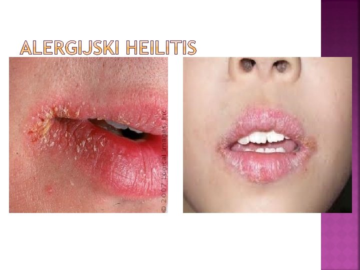 Dr sci Miljan Puleti Alergijske bolesti Imunodeficijencija Primarne