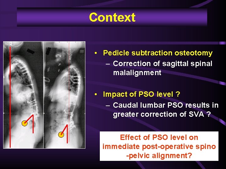 Does vertebral level of Pedicle Subtraction Osteotomy correlate