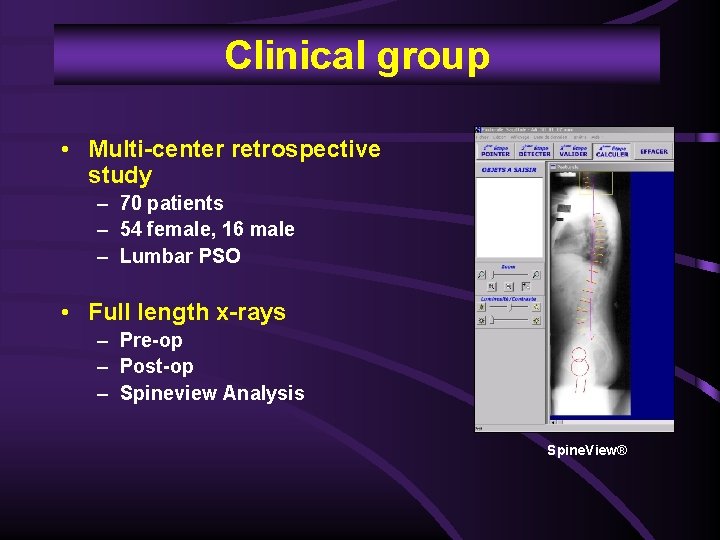 Does vertebral level of Pedicle Subtraction Osteotomy correlate