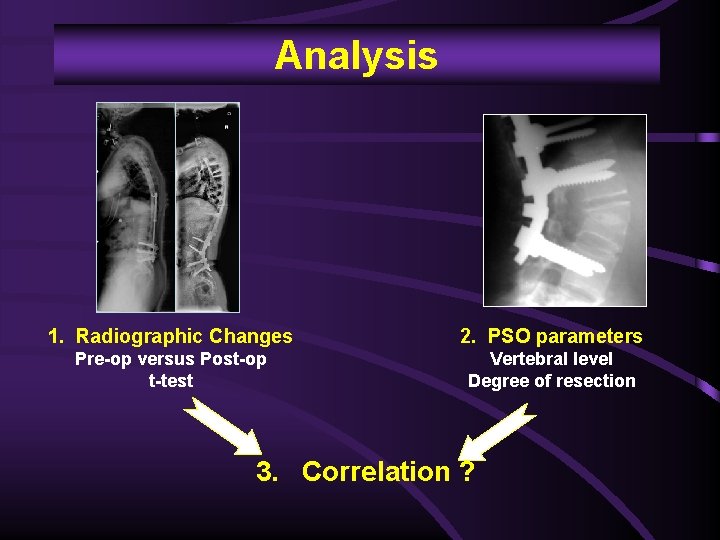 Does vertebral level of Pedicle Subtraction Osteotomy correlate