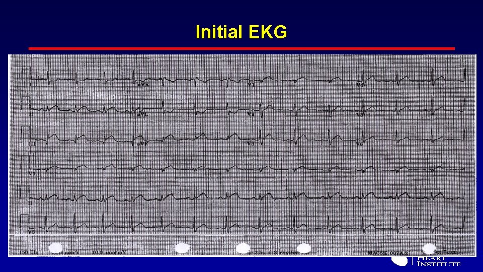 Culprit vs Multivessel Intervention in STEMI Treat them