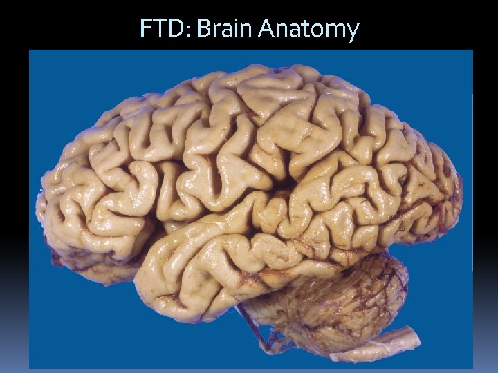 An Overview of Frontotemporal Dementia and NonAlzheimers Dementias