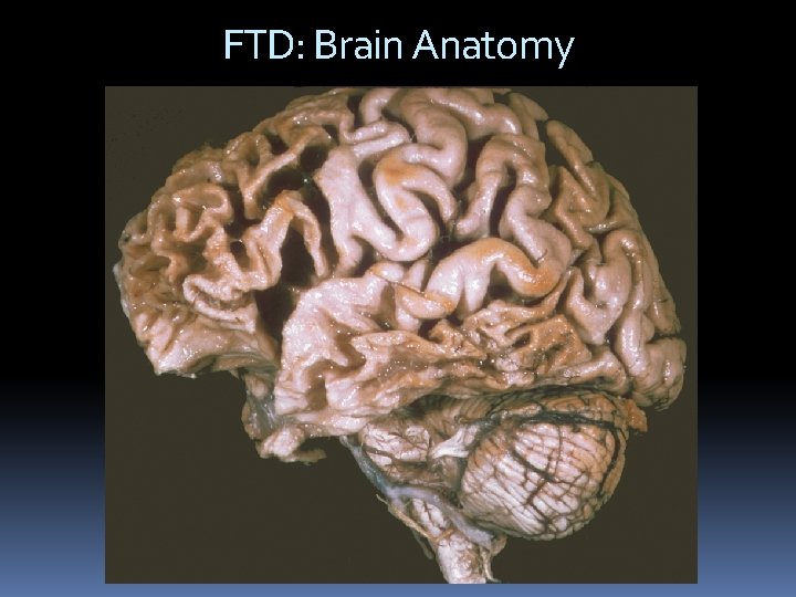 An Overview of Frontotemporal Dementia and NonAlzheimers Dementias
