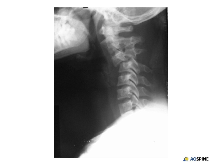 Cervical bifacetal dislocation with neurological deficit Pathology Spinal