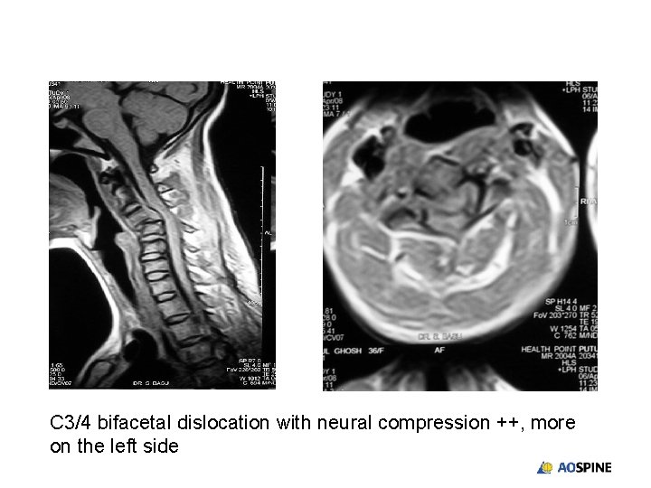 Cervical bifacetal dislocation with neurological deficit Pathology Spinal