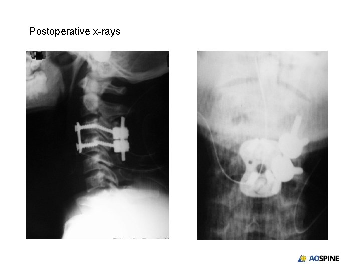 Cervical bifacetal dislocation with neurological deficit Pathology Spinal