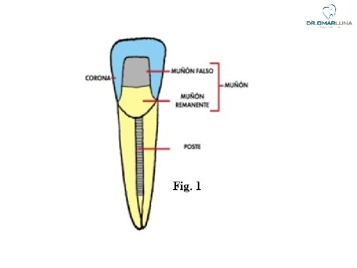 Generalidades de Postes Intraradiculares Retencin habilidad de un
