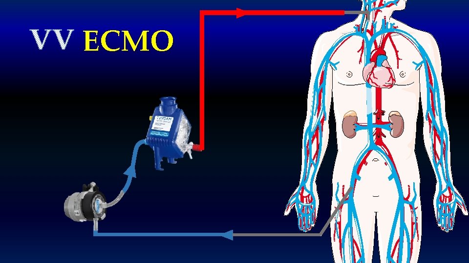 Extracorporeal Life Support ECLS Anupol Panitchote MD Division