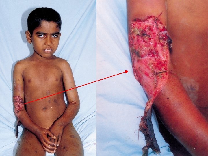 Prevention and Control of Rabies Wound Management Dr