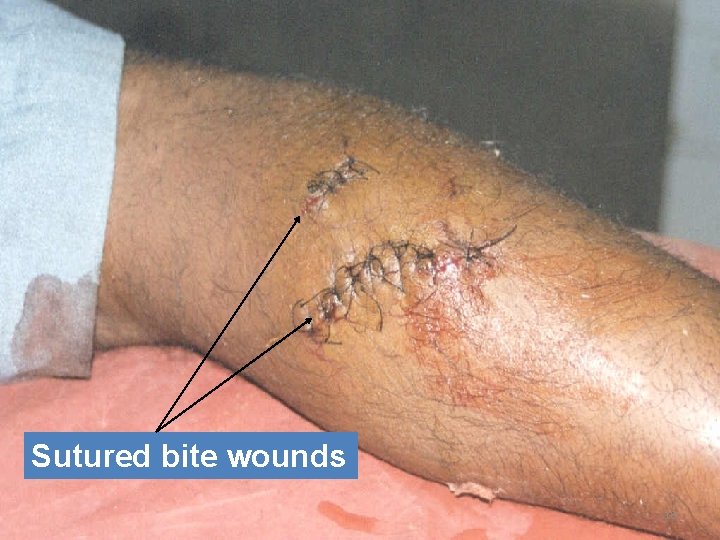 Prevention and Control of Rabies Wound Management Dr