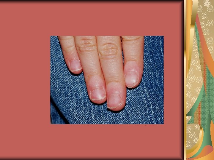 VTLGO Vitiligo is characterized clinically by development of