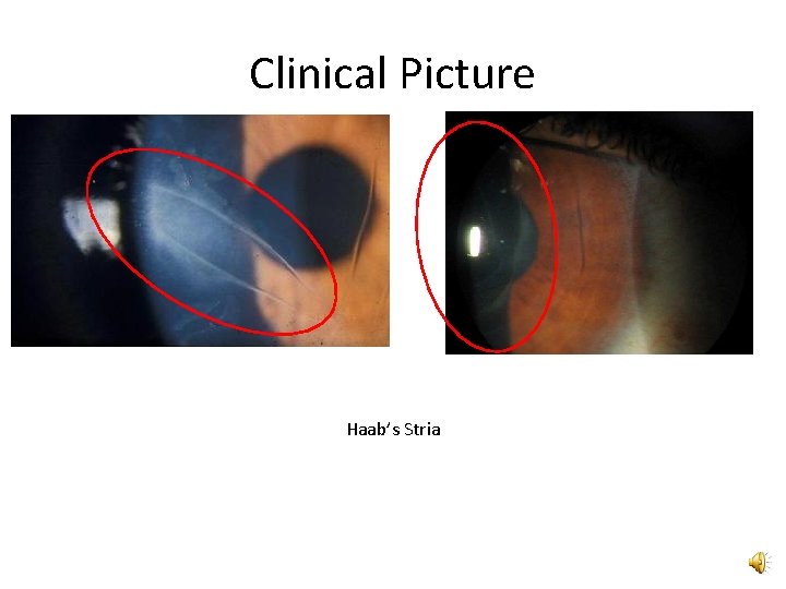 Congenital Developmental Glaucoma By Professor Nader Bayoumi MD