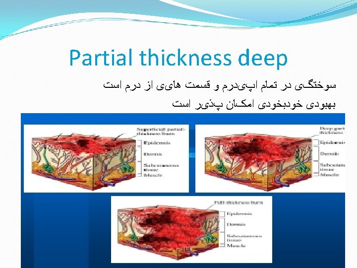 Depth of burn Partial thickness burn involves epiderm