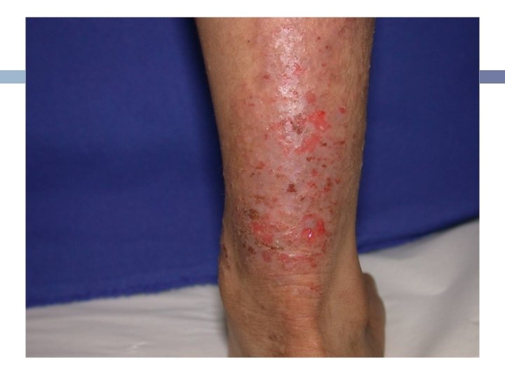 DERMATITIS AND ECZEMATOUS DISORDERS Dr Abdulmajeed Alajlan Associate