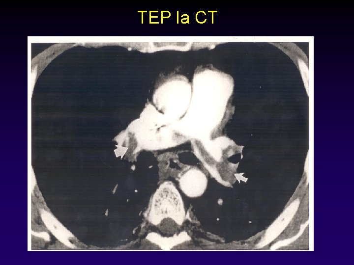 Tromboembolismul pulmonar Tromboza venoasa profunda TVP de 3