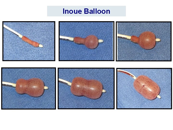 Percutaneous Mitral Valve Technique A Pichard I BenDor