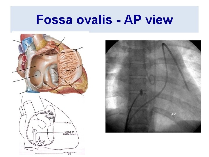 Percutaneous Mitral Valve Technique A Pichard I BenDor