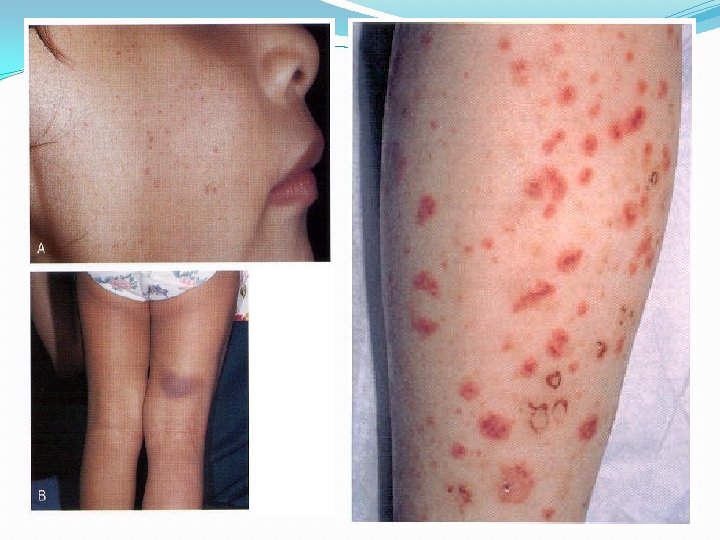 BLEEDING TENDENCY Hemostatic mechanism The normal haemostatic response