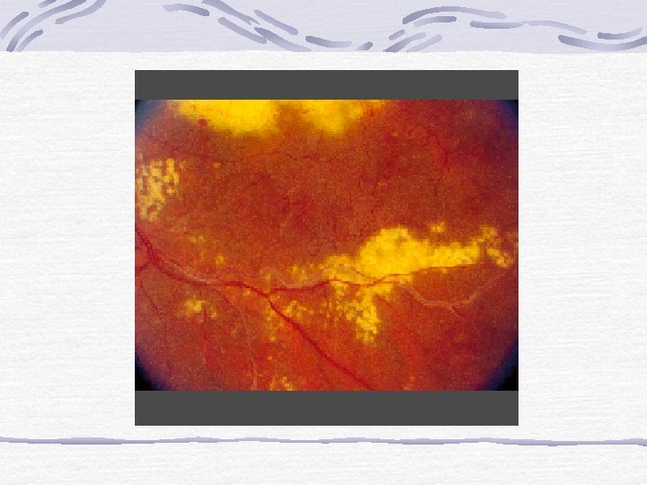 Leukocoria Causes of Leukocoria DIFFERENTIAL DIAGNOSIS OF LEUKOCORIA