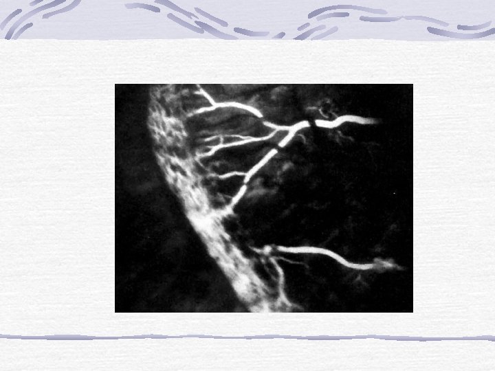 Leukocoria Causes of Leukocoria DIFFERENTIAL DIAGNOSIS OF LEUKOCORIA