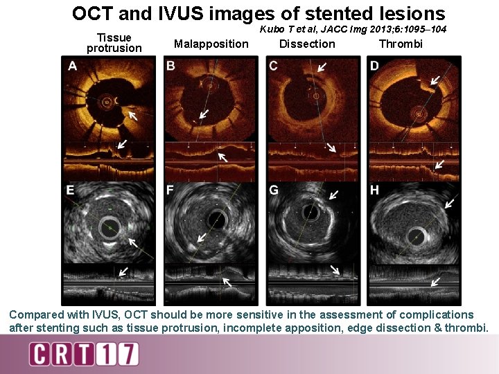 Importance of Plaque Characteristics at the Stent Edge