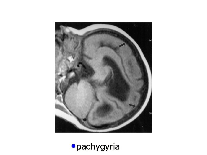 CONGENITAL ABNORMALITIES OF CENTRAL NERVOUS SYSTEM The incidence